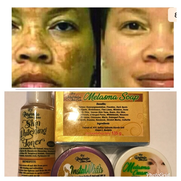 Melasma Remover | Makeup | Melasma Set Antipimples Dark Spot 0 ...